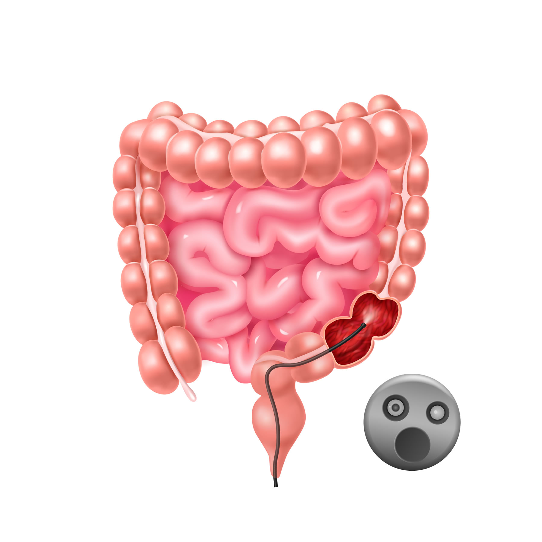 Colonoscopía - Dr. Adolfo Rivas Cajina